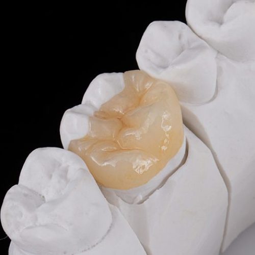 Incrustaciones Dentales – Suárez Rivaya